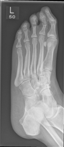 Midfoot Arthritis - Consultant Podiatric Surgeon - Jonathan Larholt
