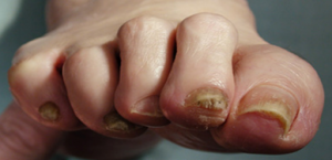 Toe / Digital Deformities - Consultant Podiatric Surgeon - Jonathan Larholt