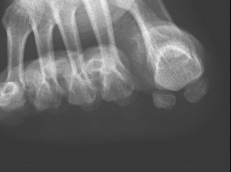 Sesamoiditis - Consultant Podiatric Surgeon - Jonathan Larholt